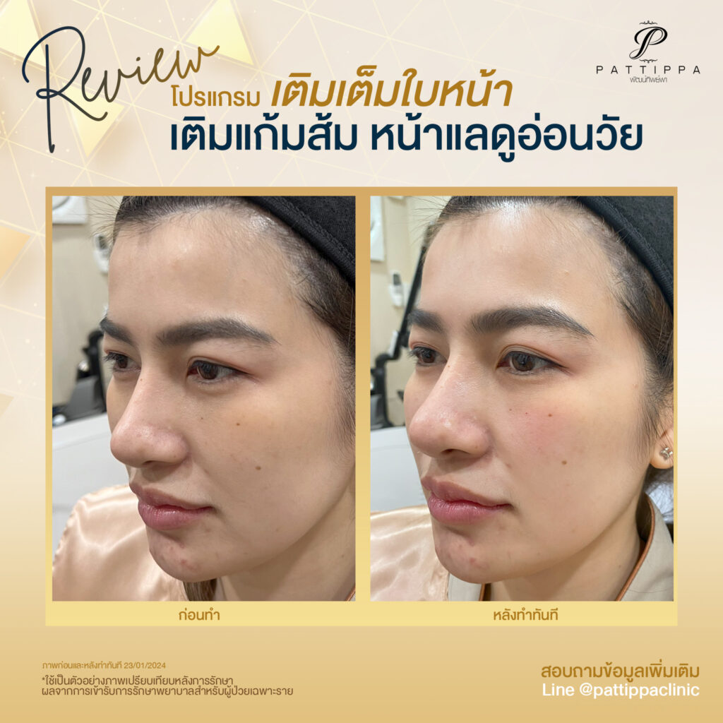 รีวิว โปรแกรม Facial Design - Pattippa Clinic